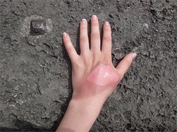 झुलस जाए स्किन तो डाक्टरी इलाज से पहले अपनाएं ये देसी ट्रिक ...